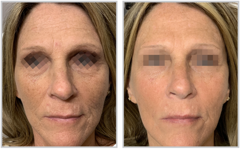Sciton BBL HERO Rochester | Laser Treatment | OcuSight Eye