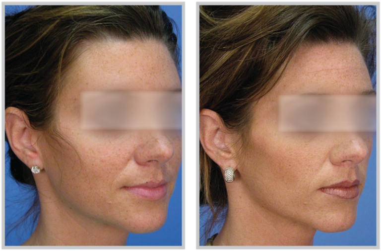 Sciton Micro Laser Peel Rochester | Laser Treatment Rochester