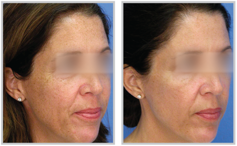 Sciton Micro Laser Peel Rochester | Laser Treatment Rochester