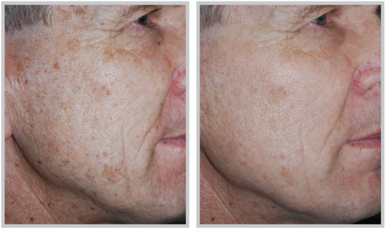 Sciton Micro Laser Peel Rochester | Laser Treatment Rochester